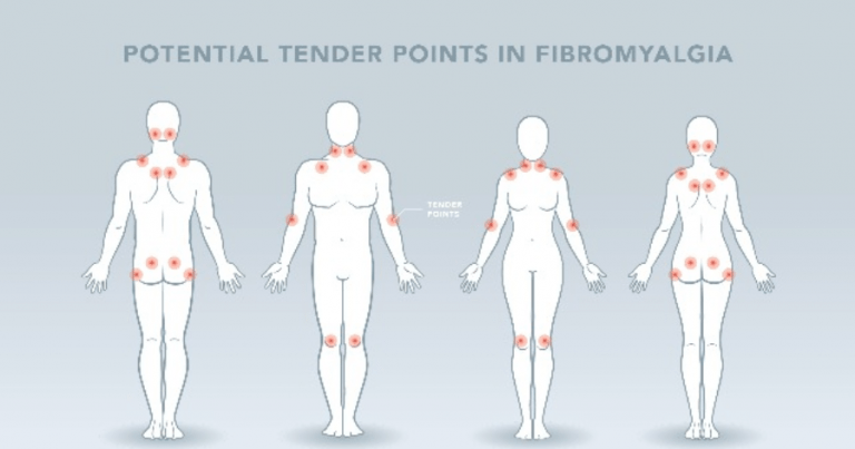Fibromyalgia & Anxiety: A Painful Connection | Advanced Sports and Spine